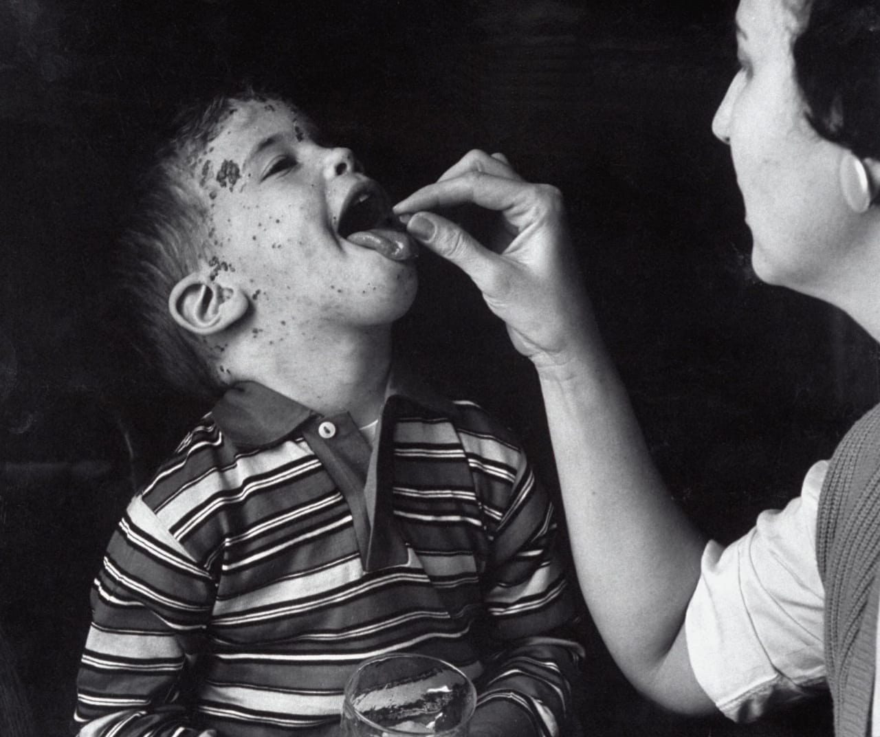 jwz: What Happened After the Chicken-Pox Vaccine?